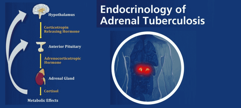 Tuberculosis And Adrenal Glands | Health Tips Blog - HealthcareOnTime