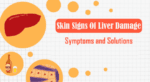 What Are the Skin Signs of Liver Damage? Symptoms and Solutions ...